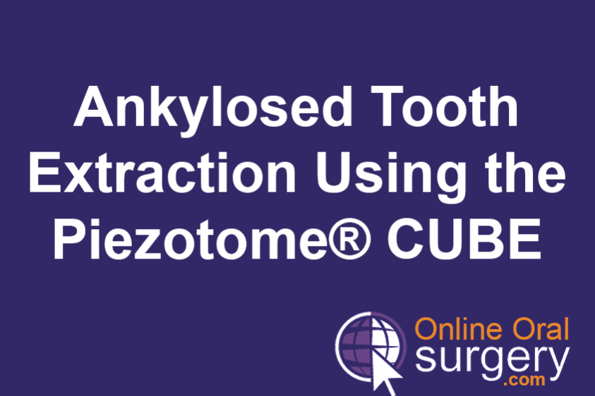 Surgical Extractions – Online Oral Surgery