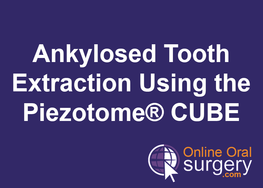 Surgical Extractions – Online Oral Surgery