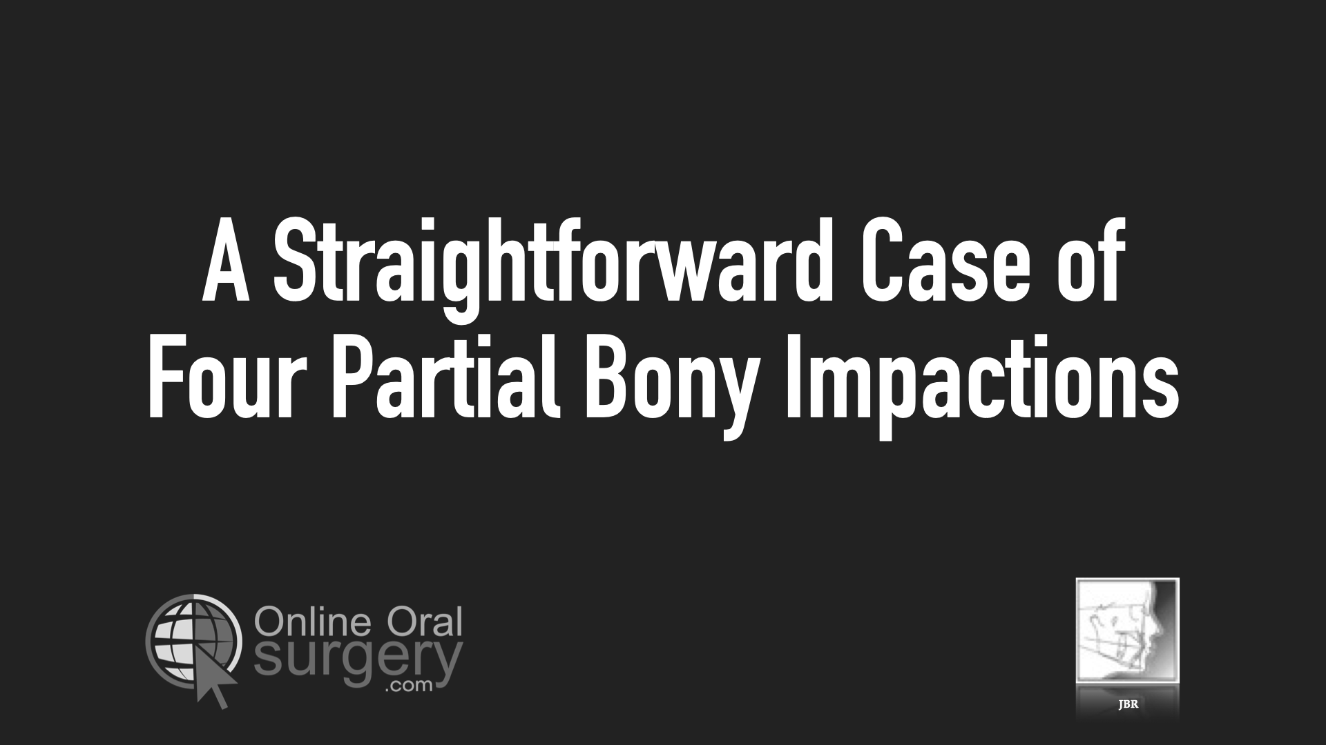 A Straightforward Case of Four Partial Bony Impactions – Online Oral ...